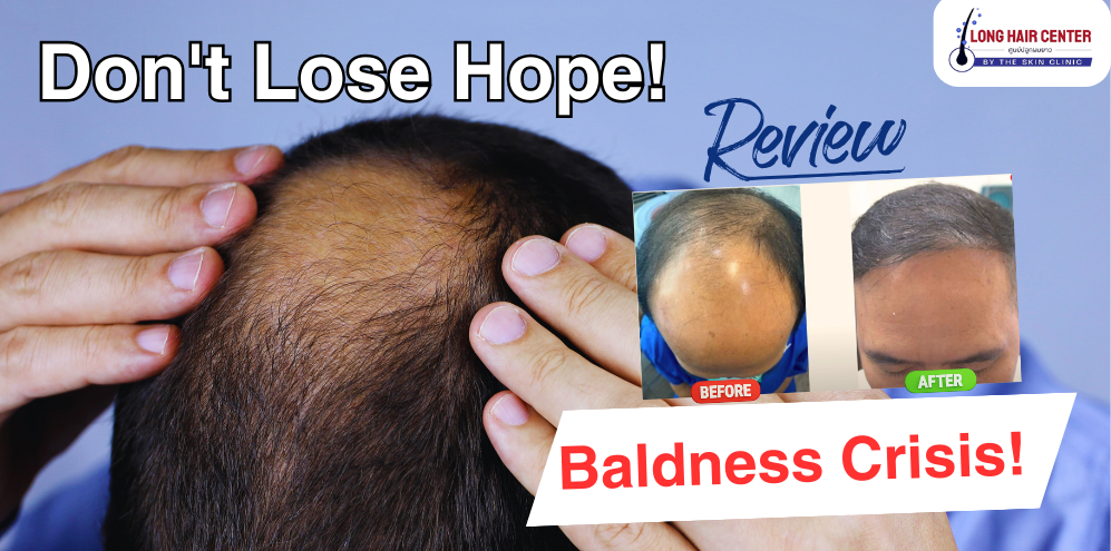 บทความให้ความรู้ ปลูกผมถาวร ปลูกผม FUE ไร้รอยแผล ไม่ต้องผ่าตัด